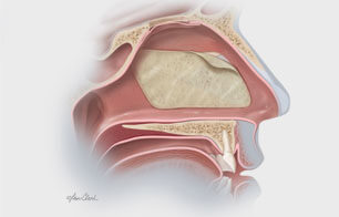 Otolaryngology | Cook Medical