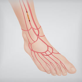 Peripheral Intervention | Cook Medical