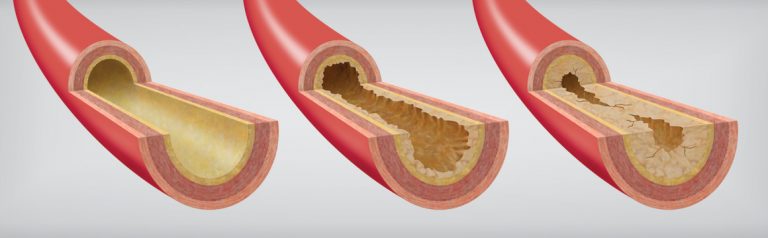 PAD awareness can save life and limb | Peripheral Intervention