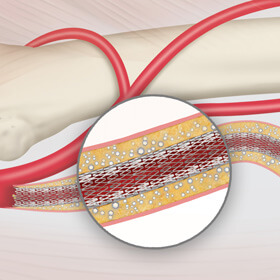 Peripheral Intervention | Cook Medical