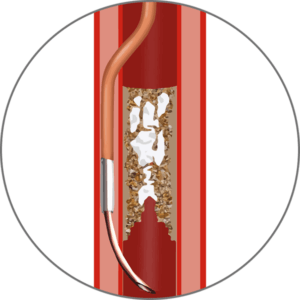 BeBack Crossing Catheter | Cook Medical