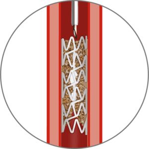 BeBack Crossing Catheter | Cook Medical