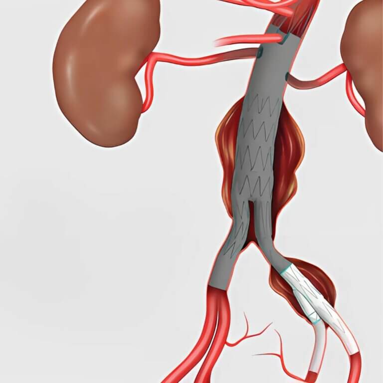 Zenith Iliac Branch Device now available in US; First patients treated ...