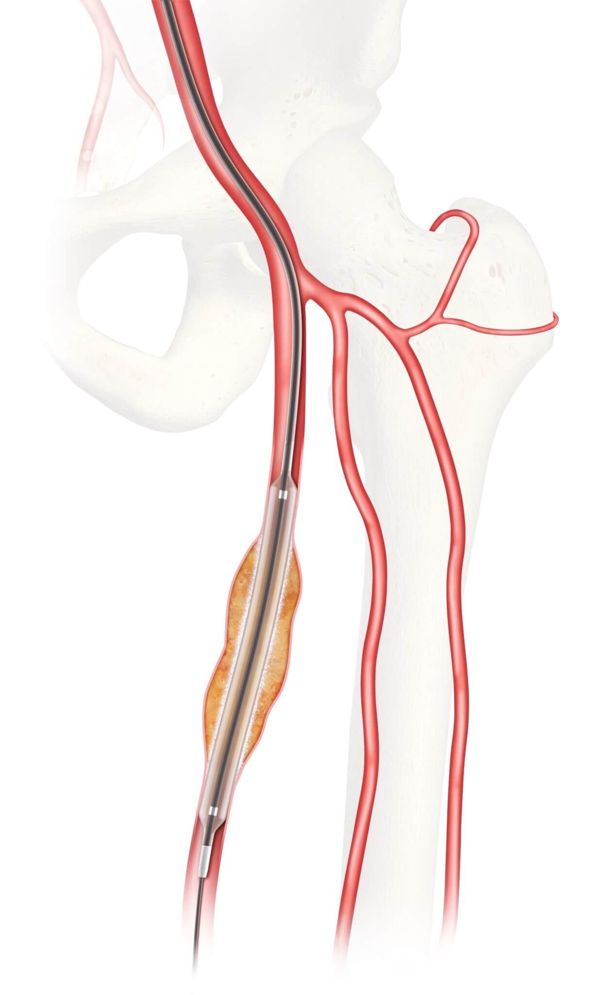 FDA approves first-of-its-kind IDE clinical study of Advance Evero™ 18 ...