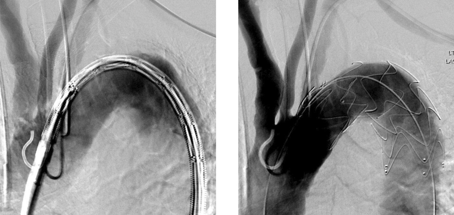 Zenith Alpha® Thoracic Endovascular Graft | Cook Medical
