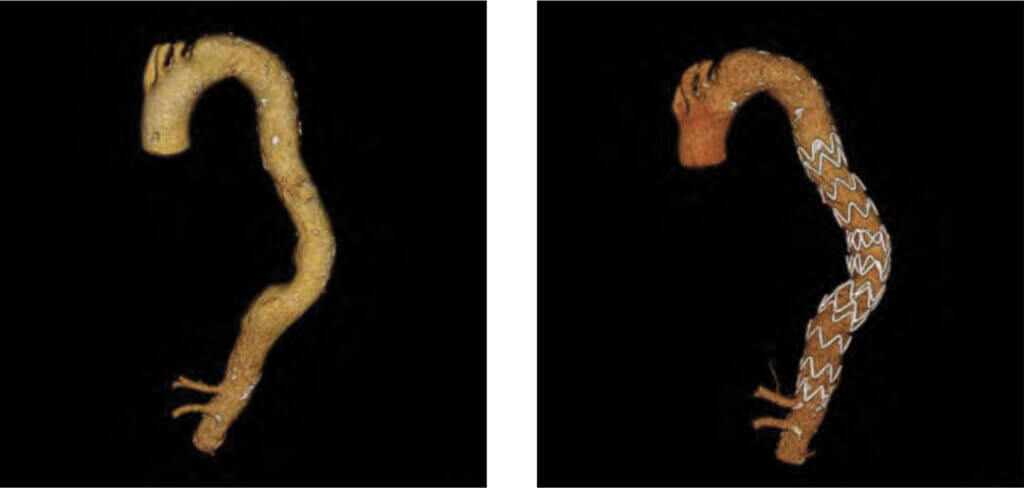 Zenith Alpha® Thoracic Endovascular Graft | Cook Medical