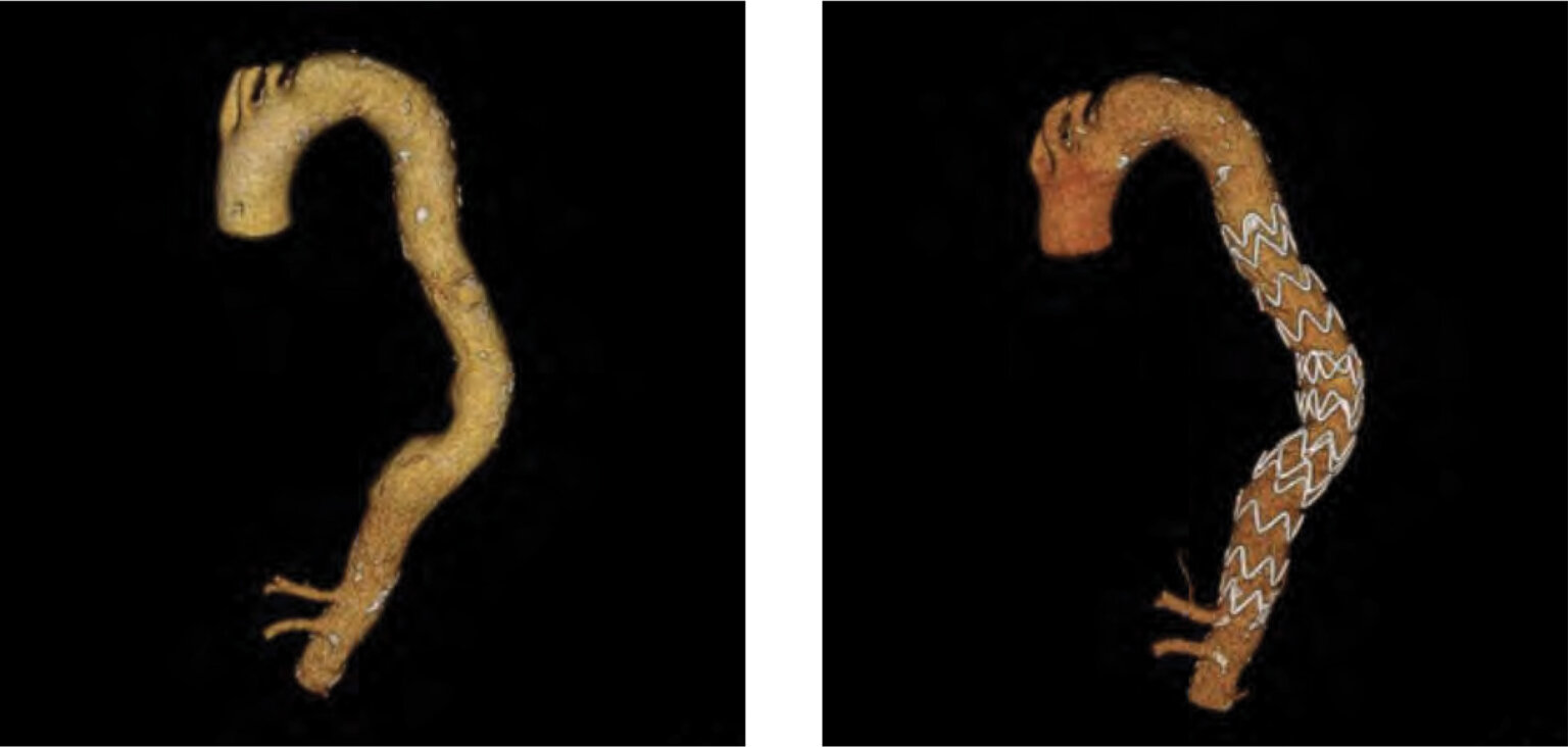 Zenith Alpha® Thoracic Endovascular Graft | Cook Medical