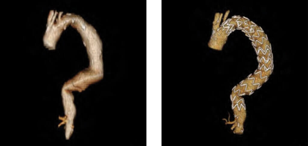 Zenith Alpha® Thoracic Endovascular Graft | Cook Medical