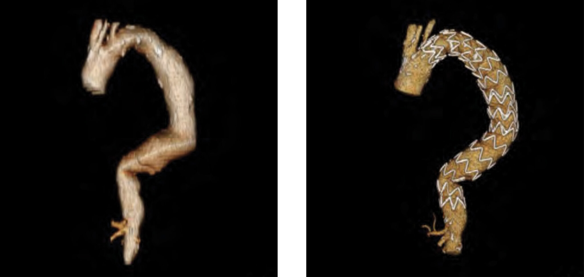 Zenith Alpha® Thoracic Endovascular Graft | Cook Medical