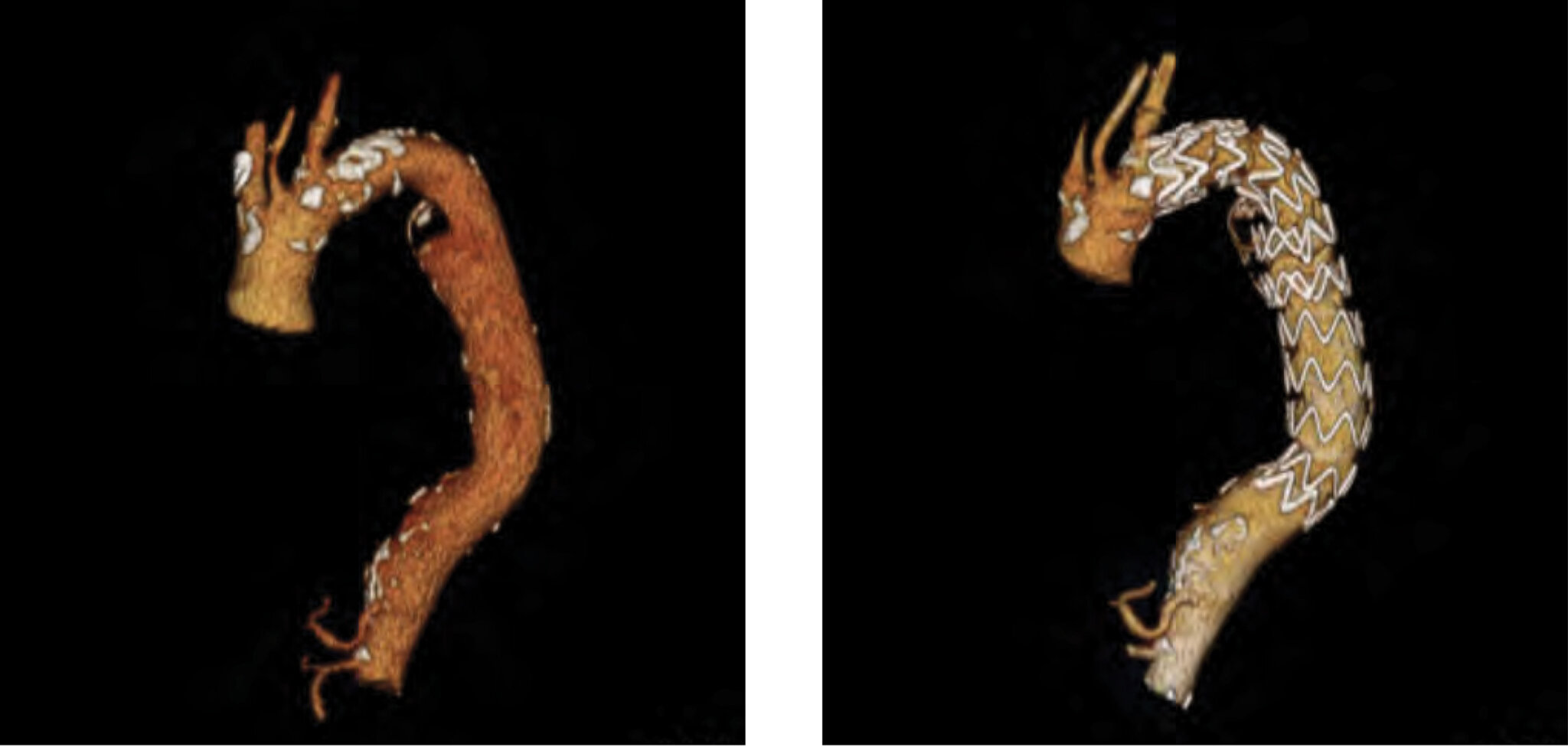 Zenith Alpha® Thoracic Endovascular Graft | Cook Medical