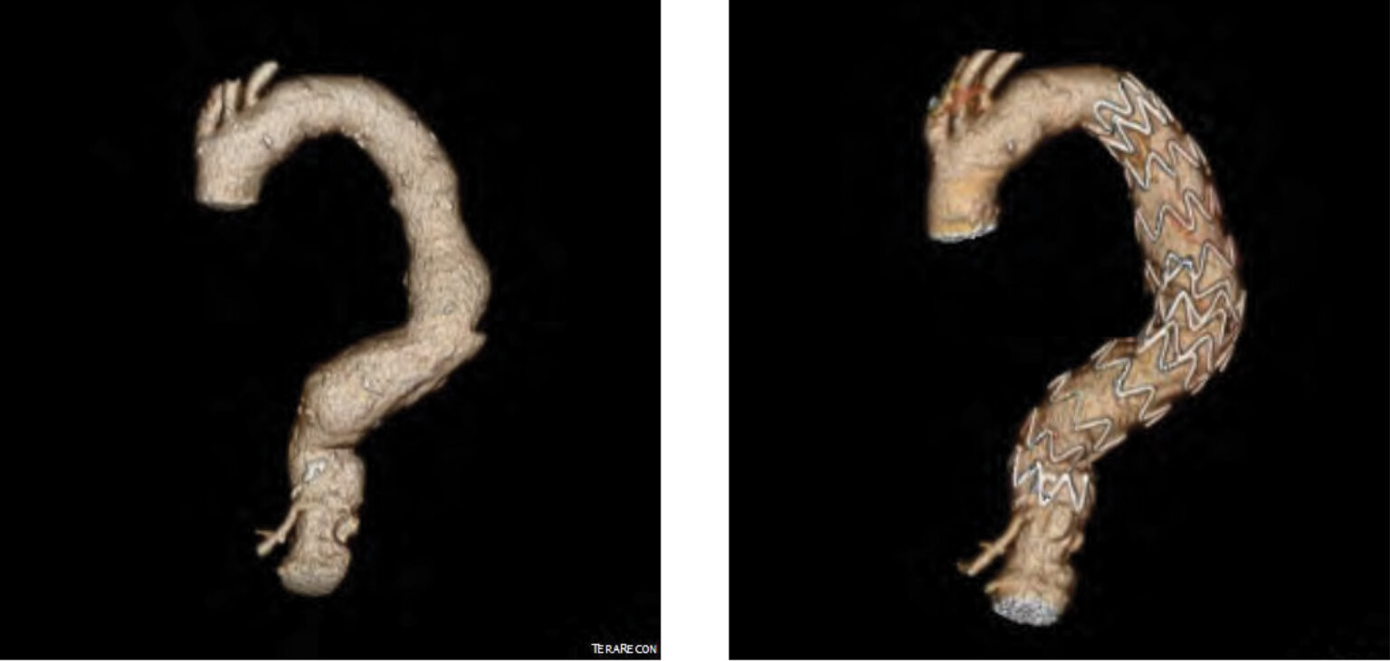 Zenith Alpha® Thoracic Endovascular Graft | Cook Medical