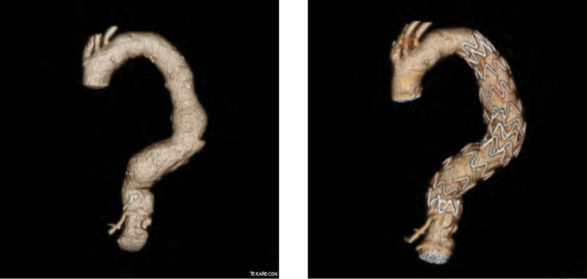 Zenith Alpha® Thoracic Endovascular Graft | Cook Medical