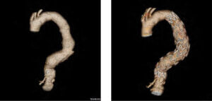 Zenith Alpha® Thoracic Endovascular Graft | Cook Medical