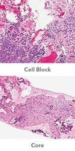 Cytology, cell block or core: results you can see. | Endoscopy