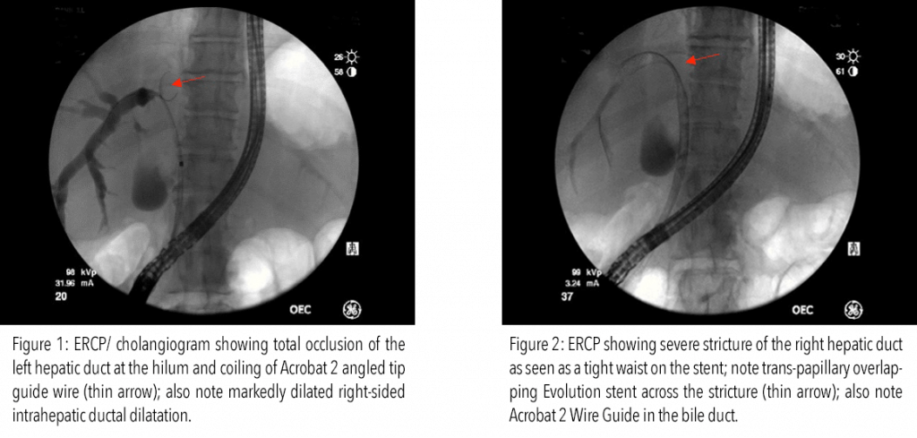 A case report: Access solutions facilitating biliary therapy | Endoscopy