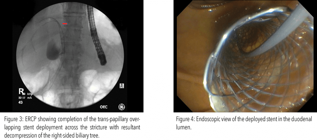 A case report: Access solutions facilitating biliary therapy | Endoscopy