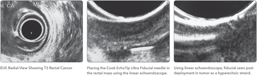 EUS-guided fiducial placement in rectal adenocarcinoma management ...