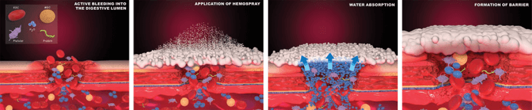 New Hemospray® data show 98% initial hemostasis in nonvariceal lower GI ...