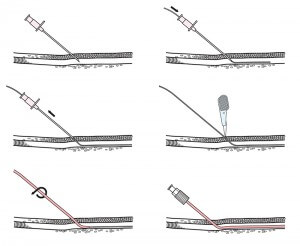 Remembering Dr. Sven Seldinger | Interventional Radiology
