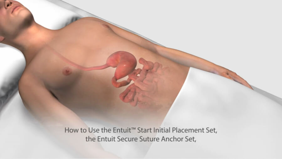 What is it like to live with a feeding tube? | Interventional Radiology