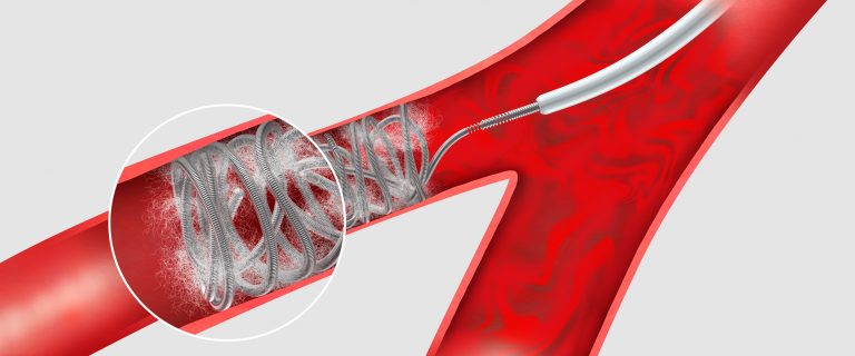 Learn about Cook Medical’s Retracta® Embolization Coil at GEST 2017 ...